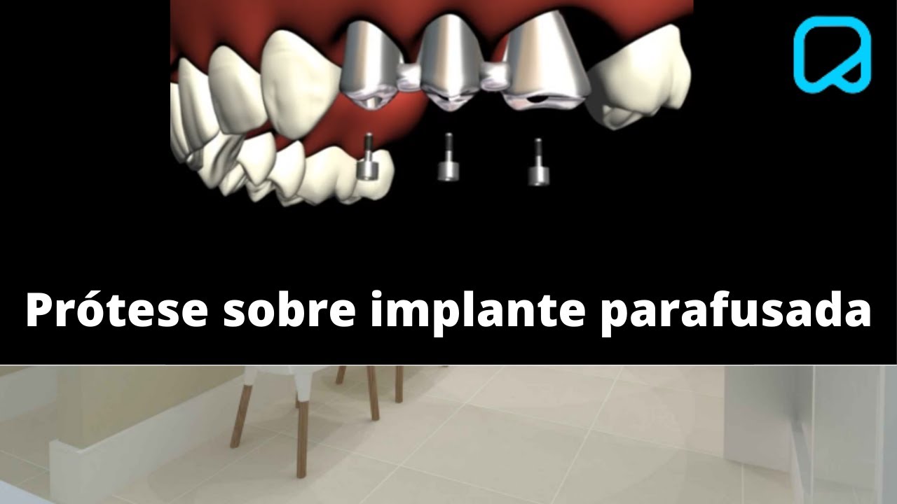 Protese sobre Implante Parafusada: Passo a Passo e Benefícios@dr ...