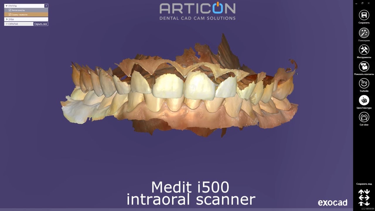 Exocad + Medit i500 intraoral scanner: single crown case - YouTube