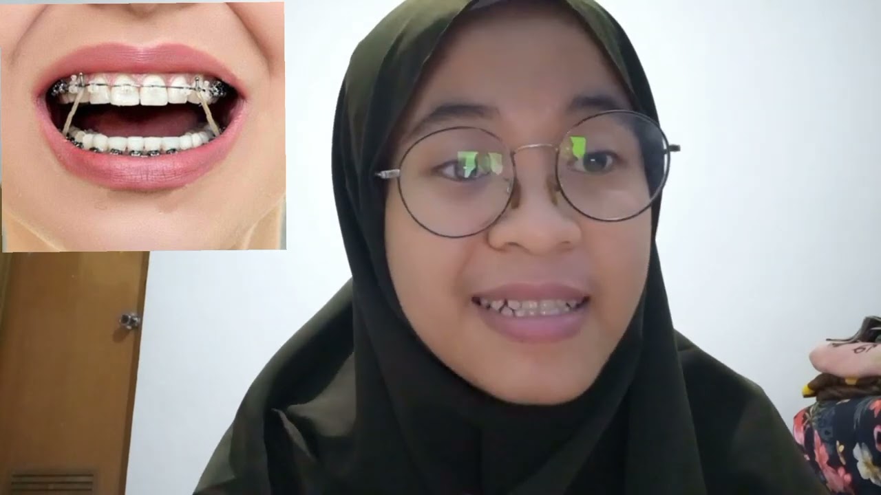 Pasang behel gigi cakil , progres 1 tahun gigi sudah rapih ? klinik ...