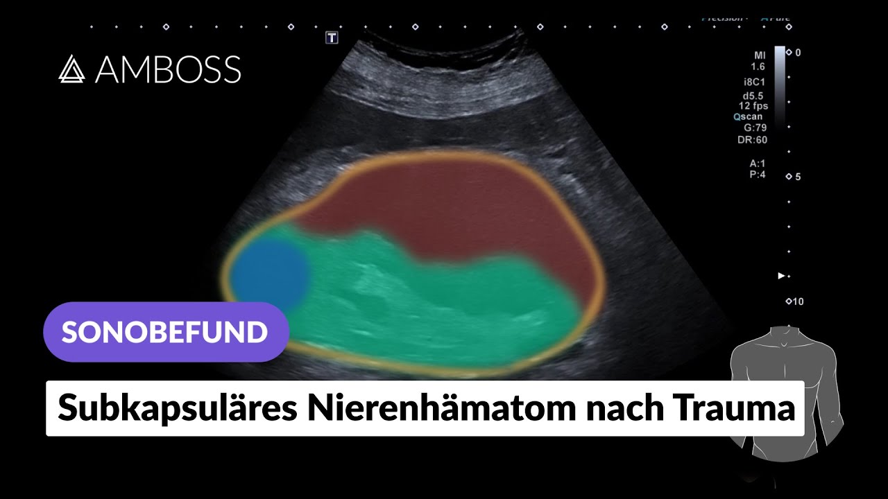 Sonobefund: Subkapsuläres Nierenhämatom nach Trauma | AMBOSS - YouTube