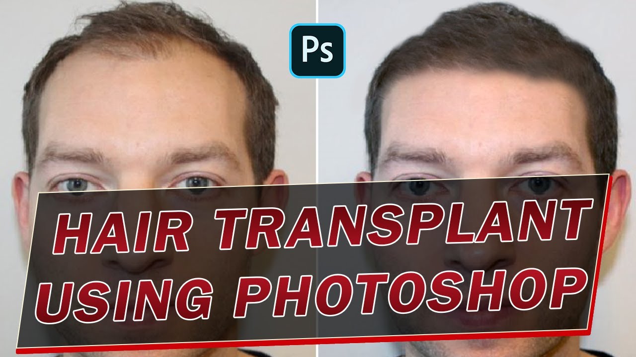 How to add hair on bald area in a photo editor | Hair Transplantation ...