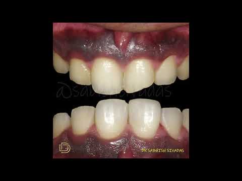 Incisal Fracture Composites - YouTube