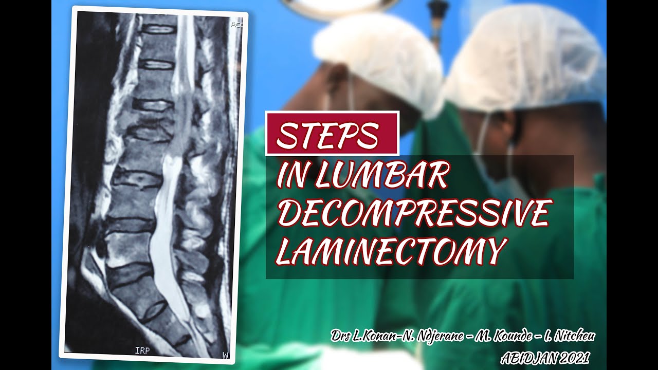 Laminectomie decompressive L2 - YouTube