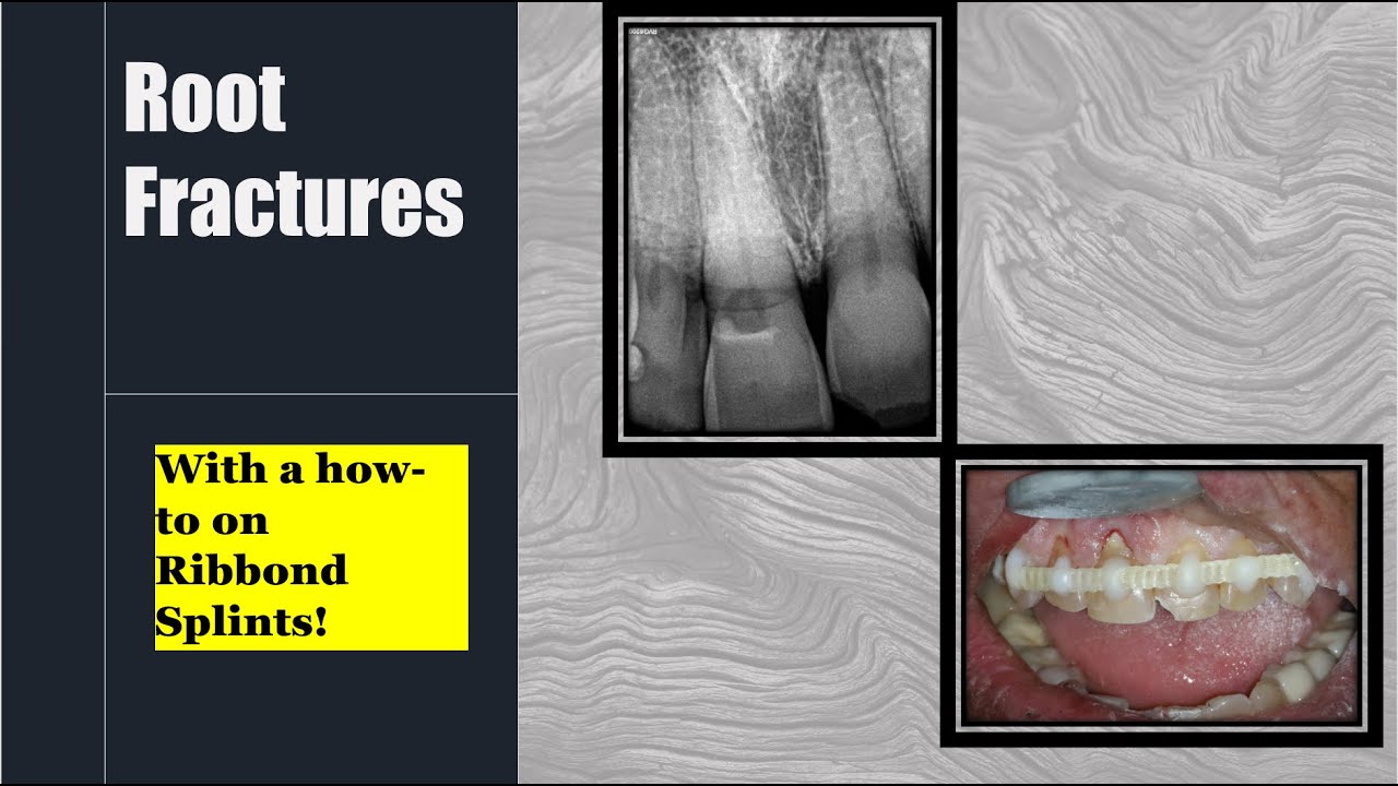 Root Fractures: Splinting Technique and More! - YouTube