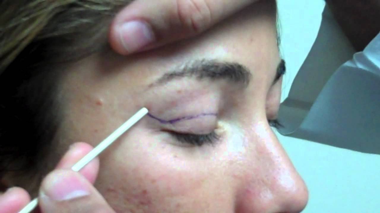 Upper Blepharoplasty Incision