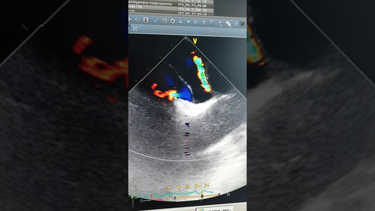 TEE bicaval view showing PFO - YouTube