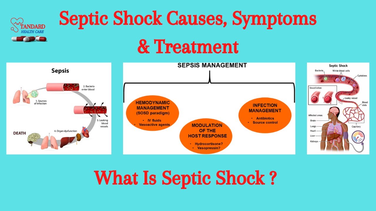 Symptoms Of Being Septic From Constipation at Tyler Curr blog