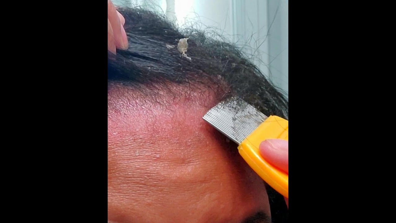 April 30, 2021/Scalp Scratching!! Huge Flakes!!! Dry Scalp!! Big ...