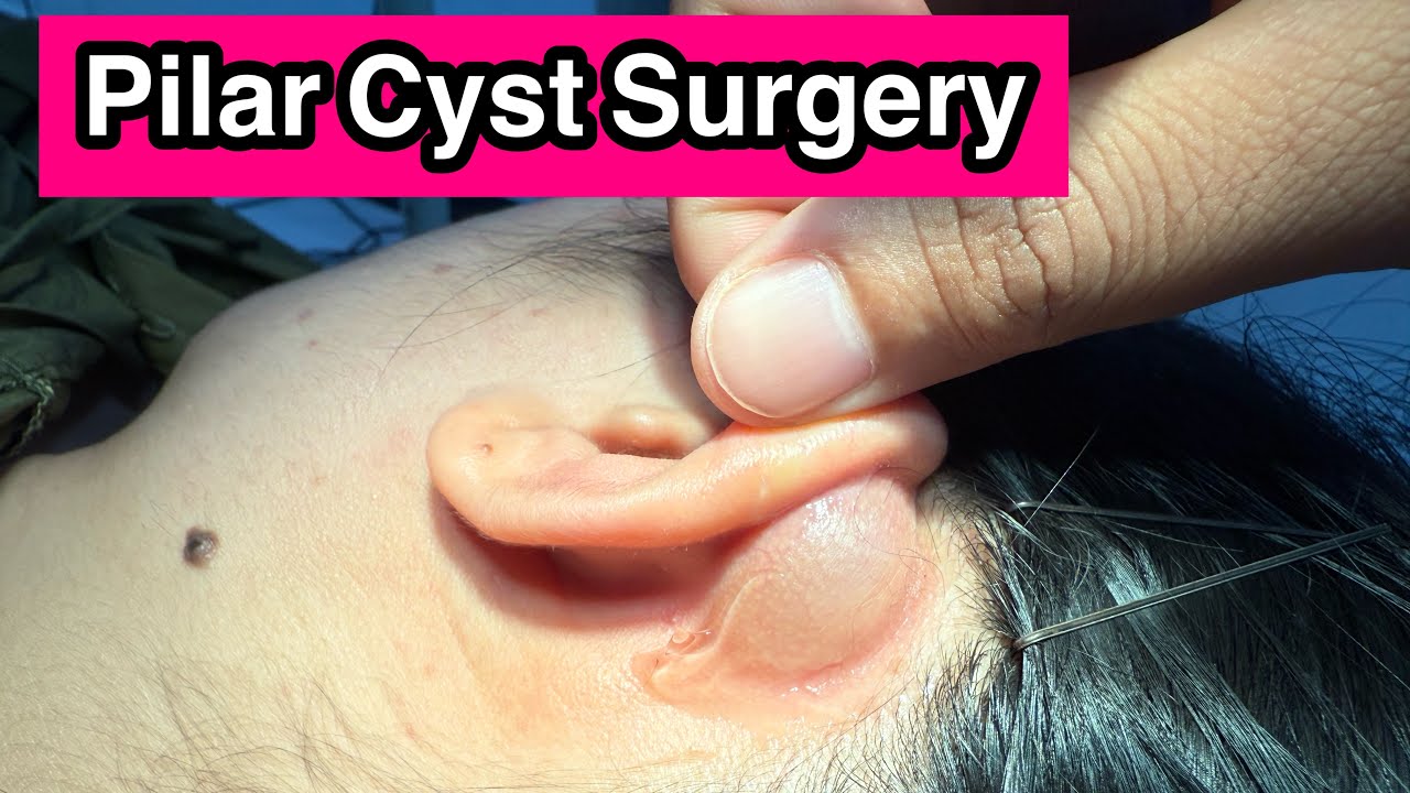 Pilar Cyst Removal Surgery - YouTube