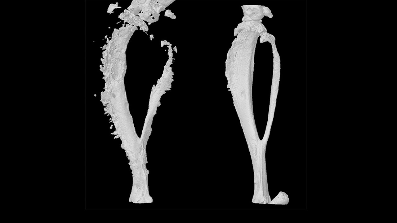 Les cancers des os : Types, Symptômes, Diagnostic et Traitement. - YouTube