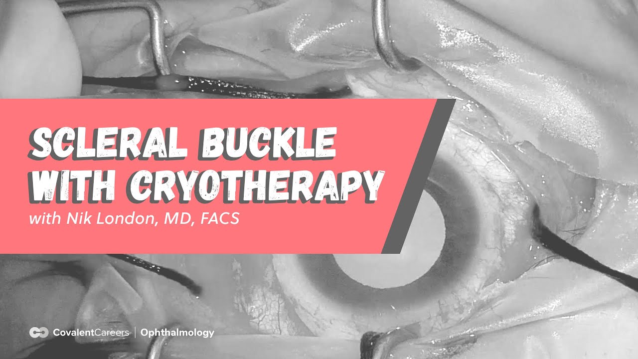 Scleral Buckle with Cryotherapy with Nik London, MD, FACS - YouTube
