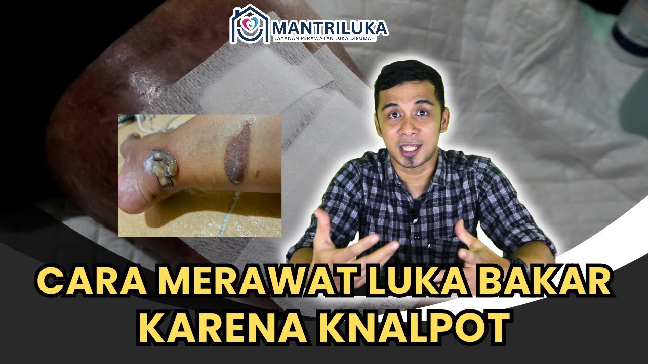 CARA MERAWAT LUKA BAKAR KARENA KNALPOT ️ - YouTube