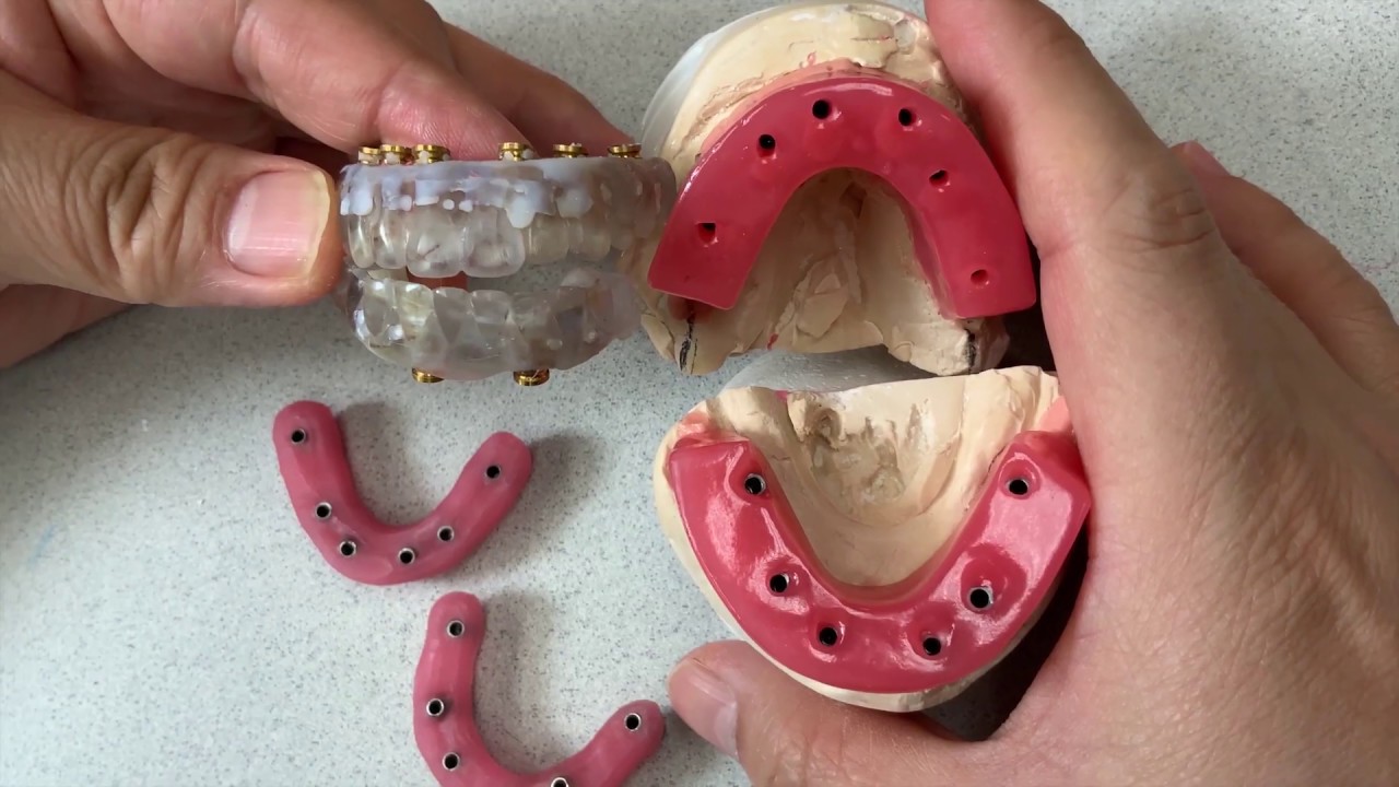 First Stage of a Full-Mouth Case! In Just 60 Seconds! - YouTube