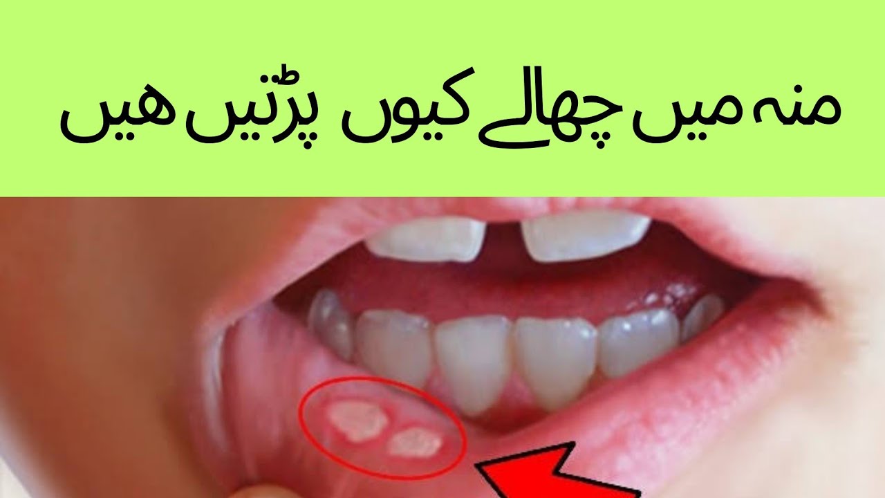 Oral Ulcers or Aphthous | causes | Treatment | Dr Javaid Iqbal Khan | # ...