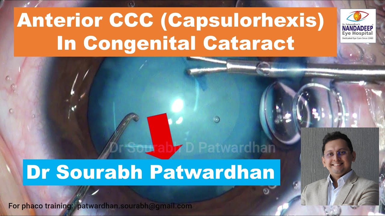 Tips for Anterior CCC (Capsulorhexis) in congenital cataract Dr Sourabh ...