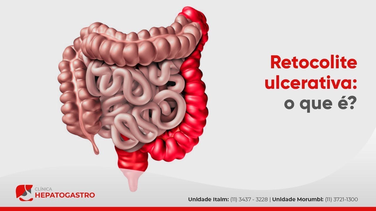 Retocolite ulcerativa: o que é? | Clínica Hepatogastro - YouTube