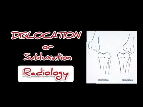 Dislocation or Subluxation of Joints - Radiology - YouTube