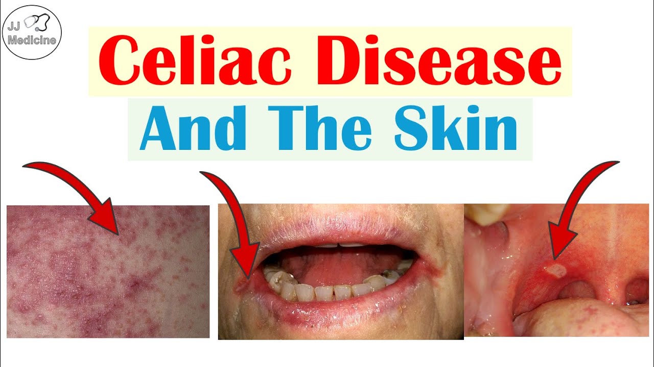4 Skin Findings of Celiac Disease | Celiac Disease and the Skin - YouTube