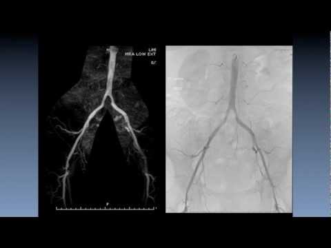 Non-Gadolinium MRA: No Contrast in Black and White, Dr. Jonathan Levine ...
