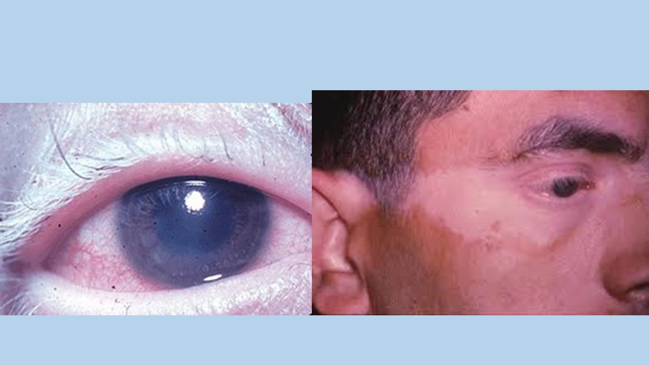 Uveitis OSCE | ophthalmology | 4th grade | Dr. Mohamed Gamal - YouTube