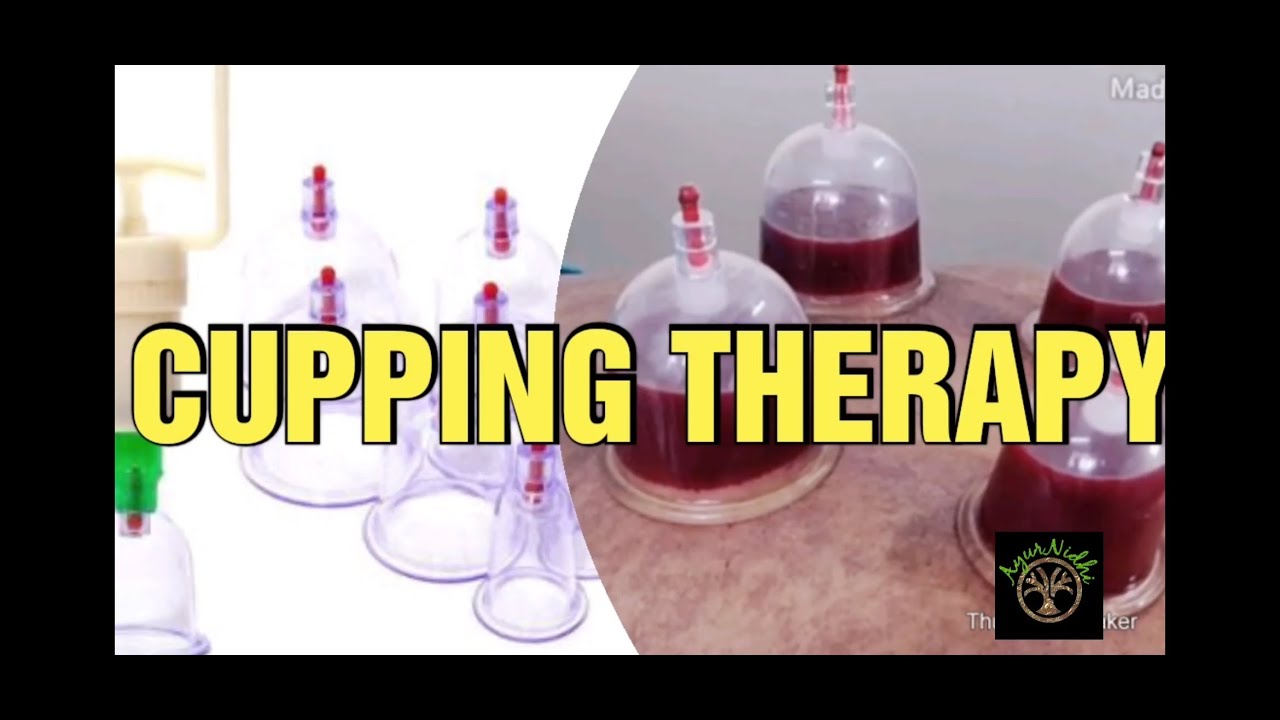 Cupping Therapy- A Practical Demonstration. - YouTube