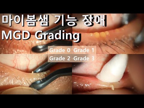 마이봄샘 기능 장애 정도 분류. MGD grading. - YouTube