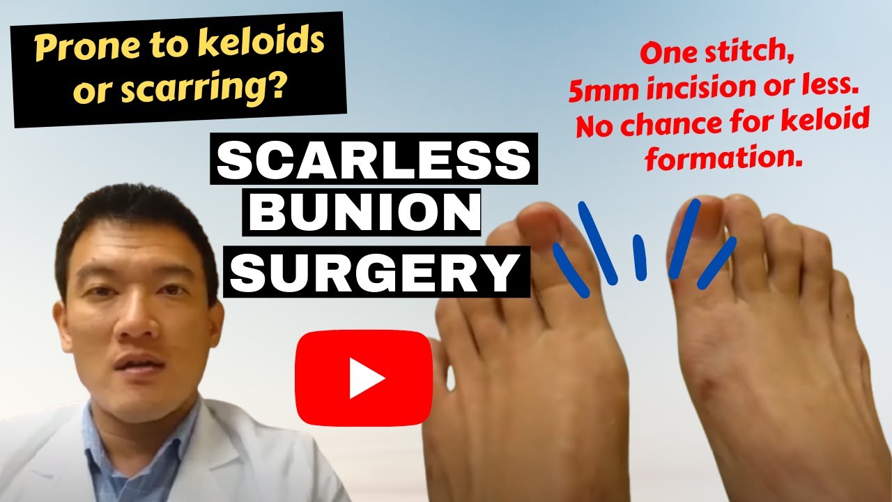 Top Bunion surgery for keloid prone patients - YouTube