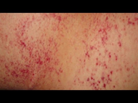 LAMP TCM & ACUPUNCTURE 06: Blood Metabolism, Kidney Yin Deficiency ...