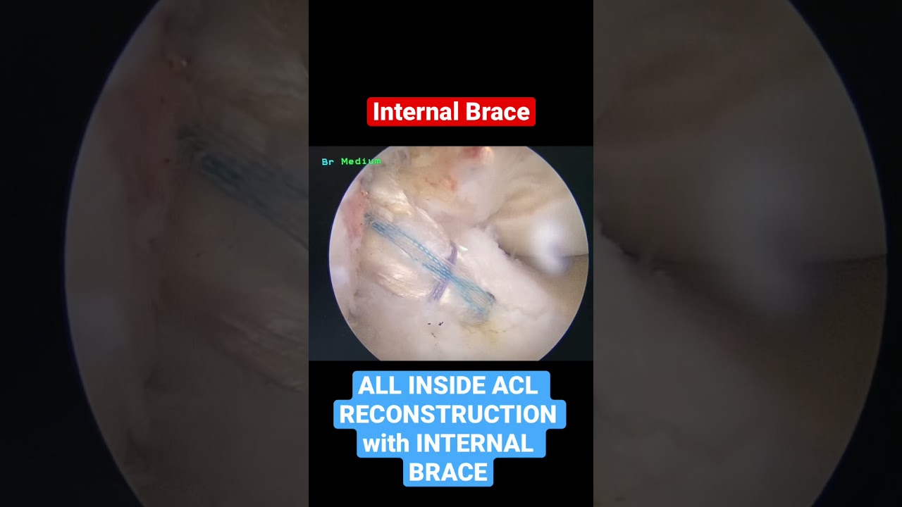 ALL INSIDE ACL RECONSTRUCTION WITH INTERNAL BRACE SURGERY - YouTube