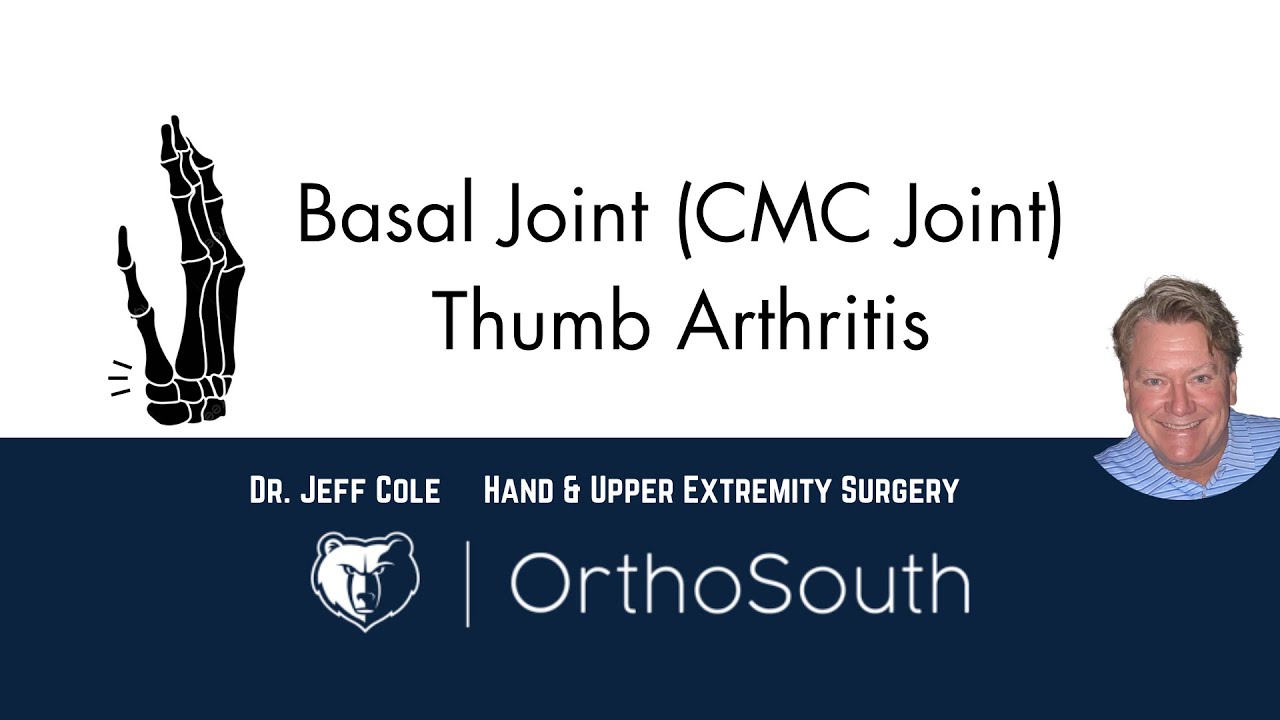 Thumb CMC Arthritis Overview - YouTube