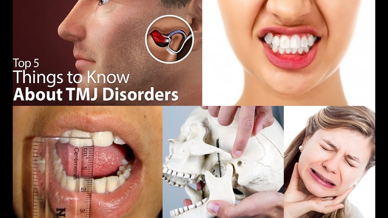 ปวดกราม กรามลั่นกึกๆ ปวดกกหู ขากรรไกรค้าง (TMD) - YouTube