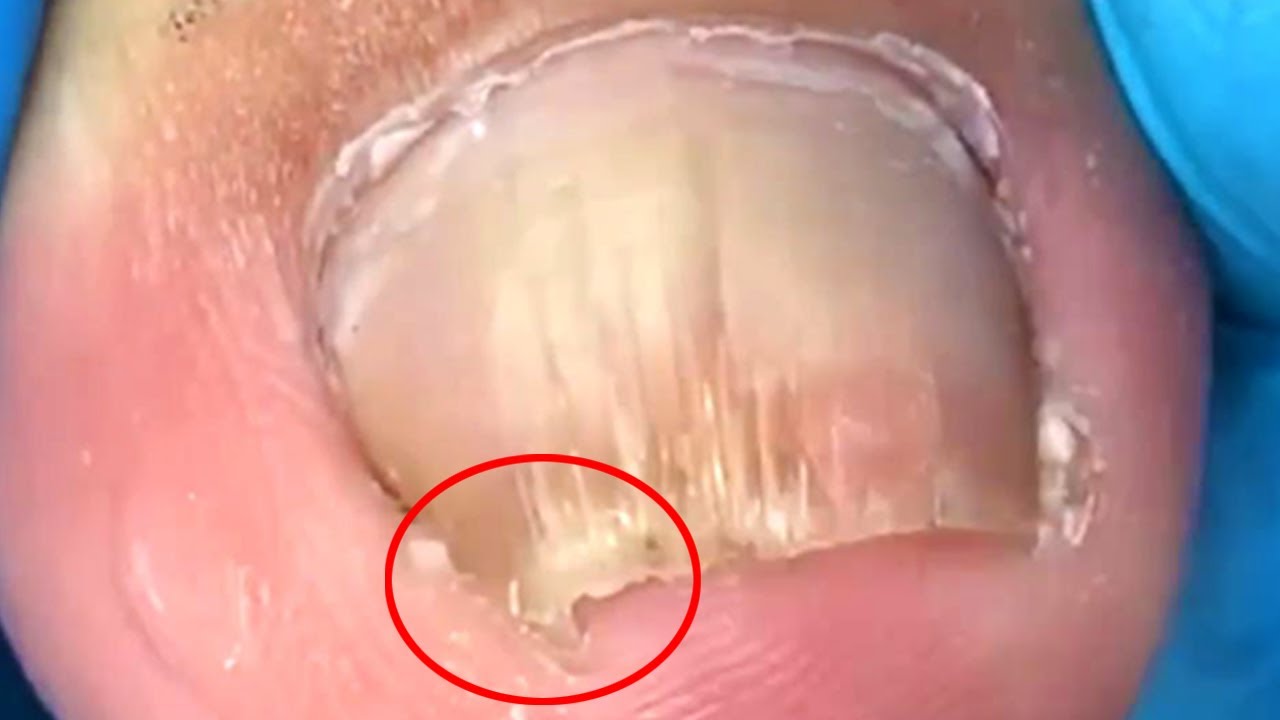 Provide patients with perfect ingrown toenail trimming #Pedicure - YouTube