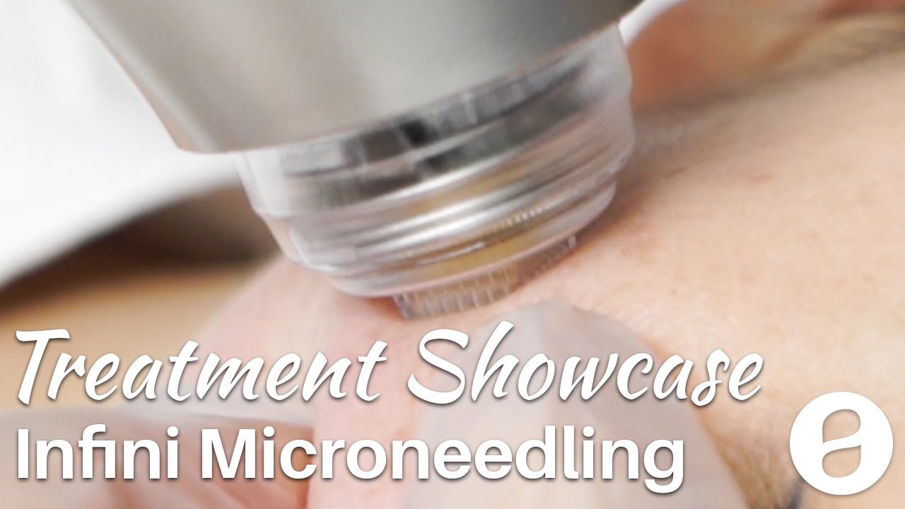 Infini RF Microneedling - Treatment Showcase - YouTube