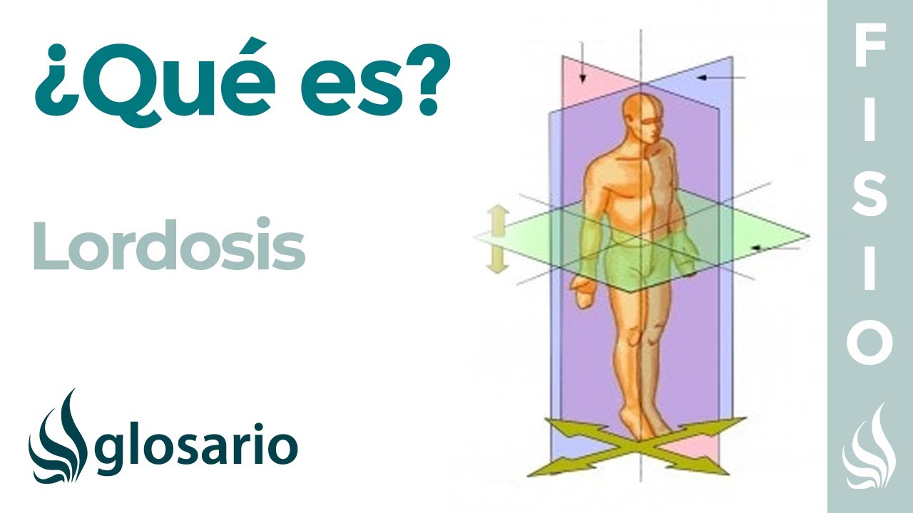 LORDOSIS | Qué es, por qué se produce, cuáles son sus síntomas y a ...
