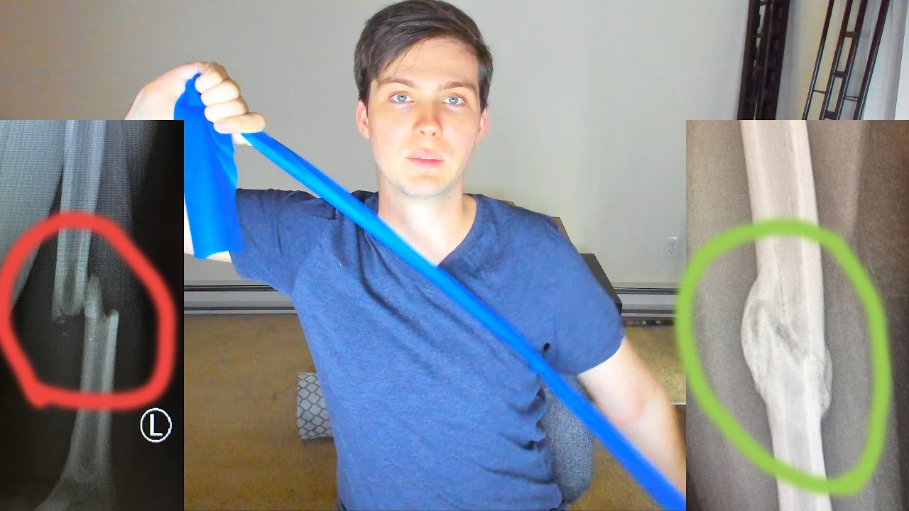 ARM IS HEALED in 3 Months! GO TIME! - YouTube