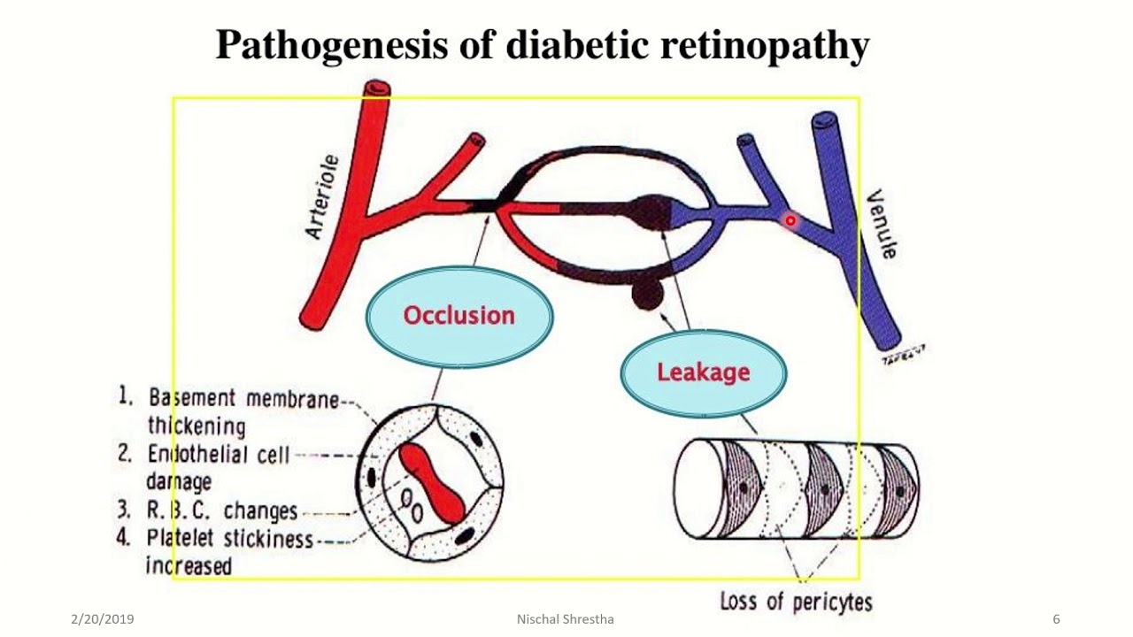 pathogenesis of Diabetic Retinopathy - YouTube