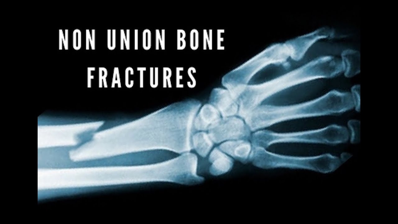 CPT Code For Repair Of Nonunion Simplify Medical Coding YouTube