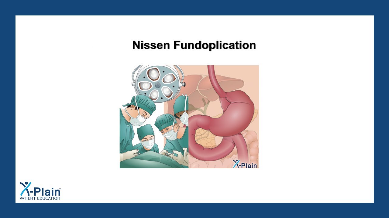 Nissen Fundoplication - YouTube