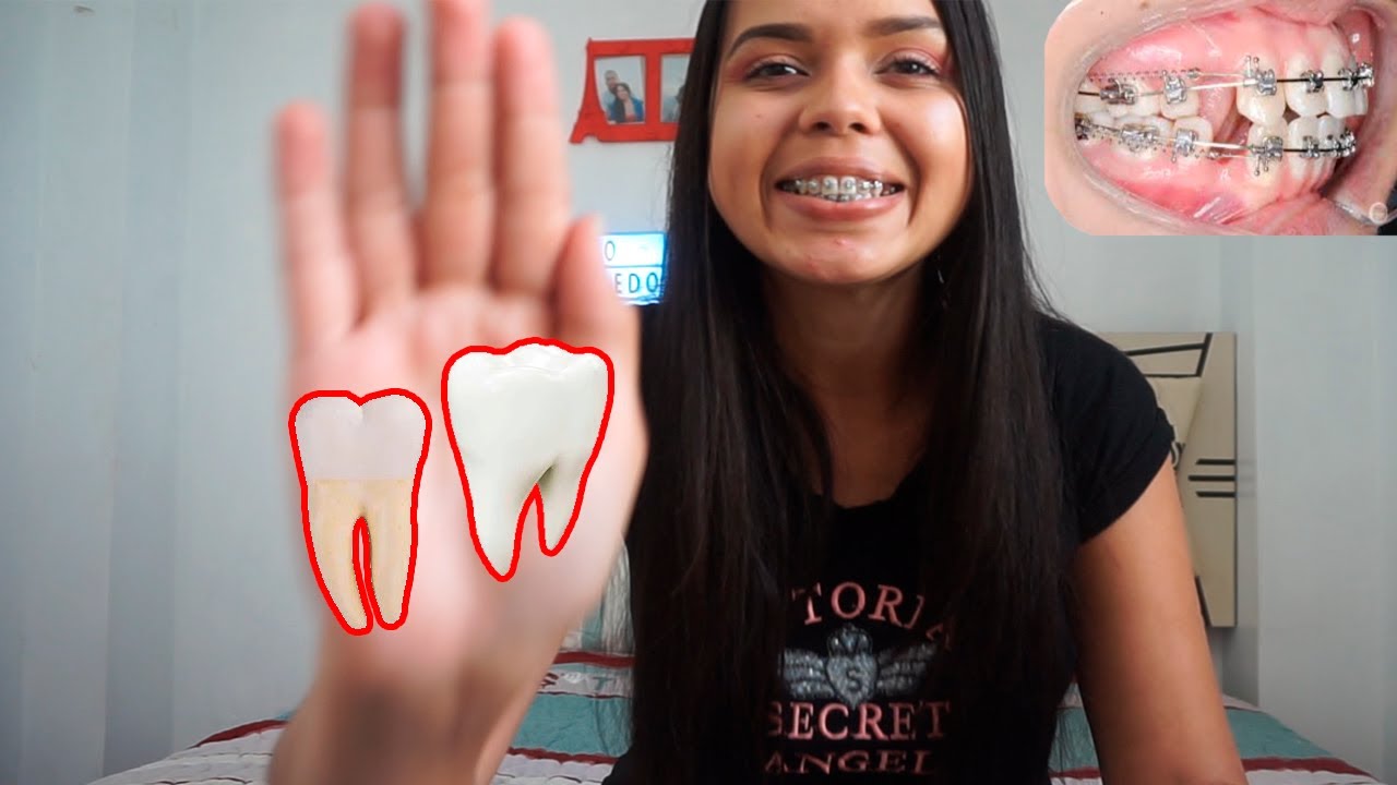 MI EXPERIENCIA CON LA ORTODONCIA, EXTRACCION DE PREMOLARES UN SUEÑO ...