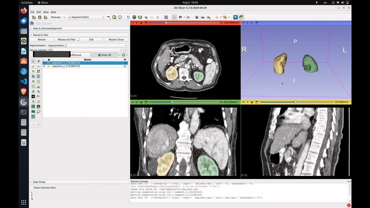 Sam2 3d Slicer Plugin Usage Youtube