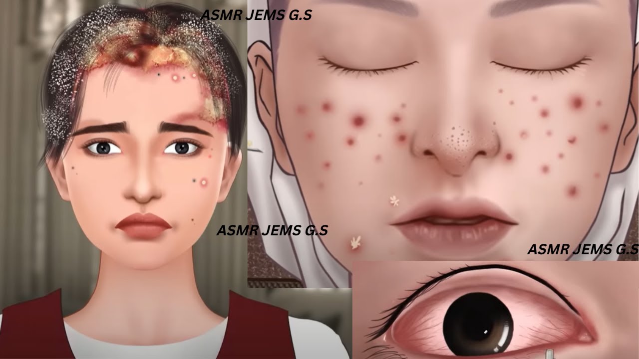 ASMR Removal acne and head lice from the nape at hairline/#brainasmr # ...