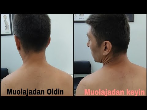 Og'riq sababli bo'ynimni qayirolmay qoldim😱