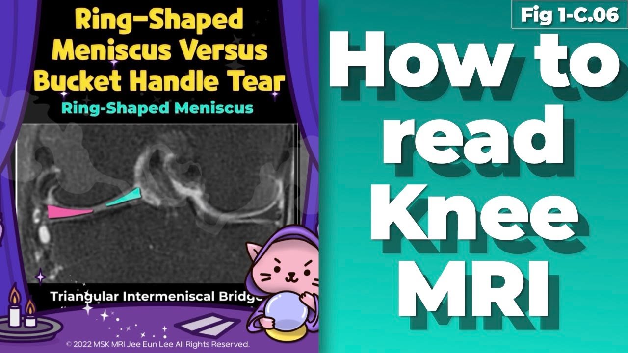 (Fig 1-C.06) Ring-shaped meniscus vs Bucket handle tear - YouTube