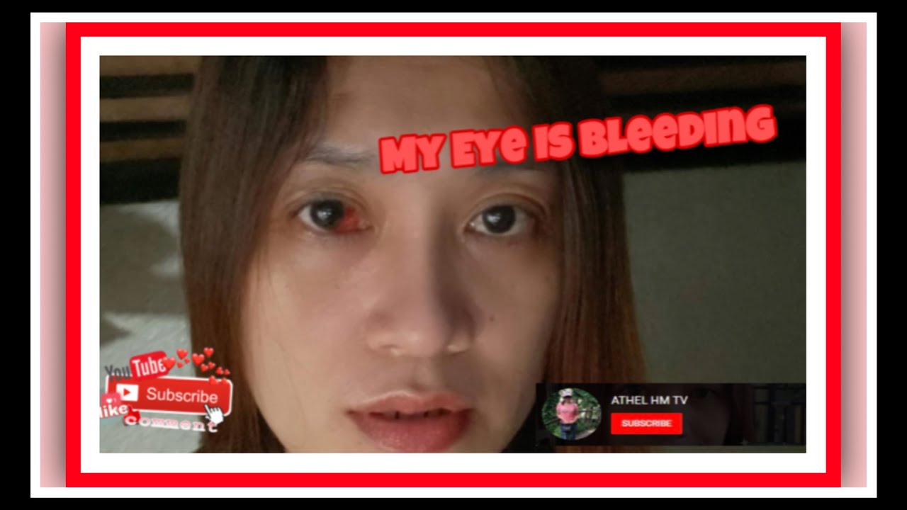 7 DAYS HEALING TIME LAPSE: BROKEN BLOOD VESSEL IN EYE| SUBCONJUNCTIVAL HEMORRHAGE|ATHEL HM TV ...