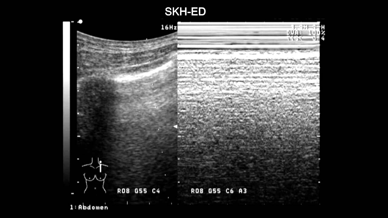 Pneumothorax Youtube