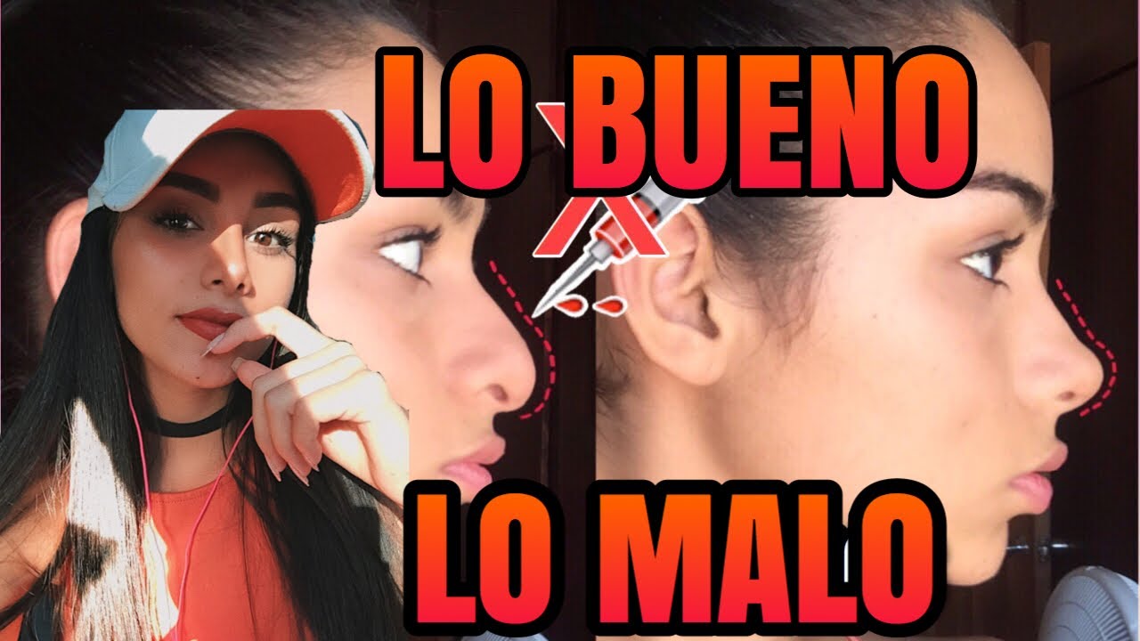 Lo BUENO y lo MALO Respingadores nasales || Rinoplastia Casera en ...