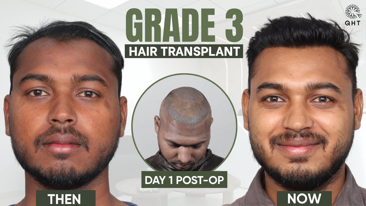 Grade 3 hair transplant | Grade 3 hair transplant before after | Grade ...