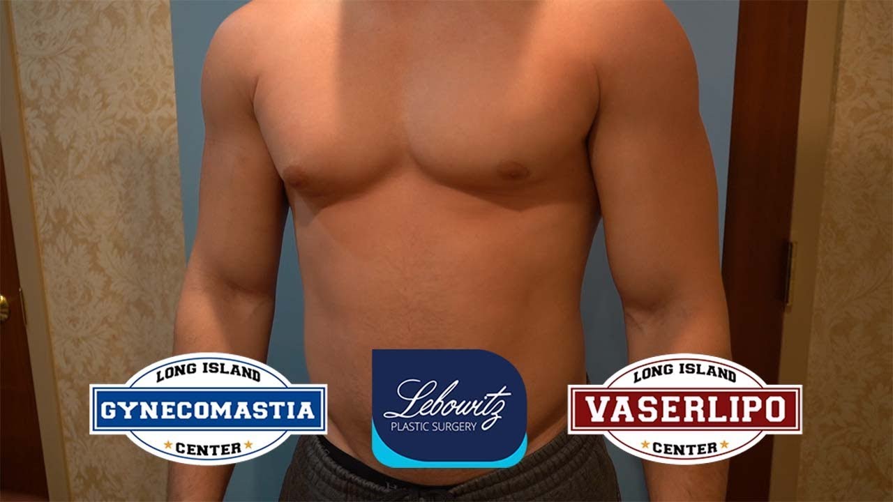 One-Sided GYNECOMASTIA Gland Removal Surgery by Dr. Lebowitz - YouTube