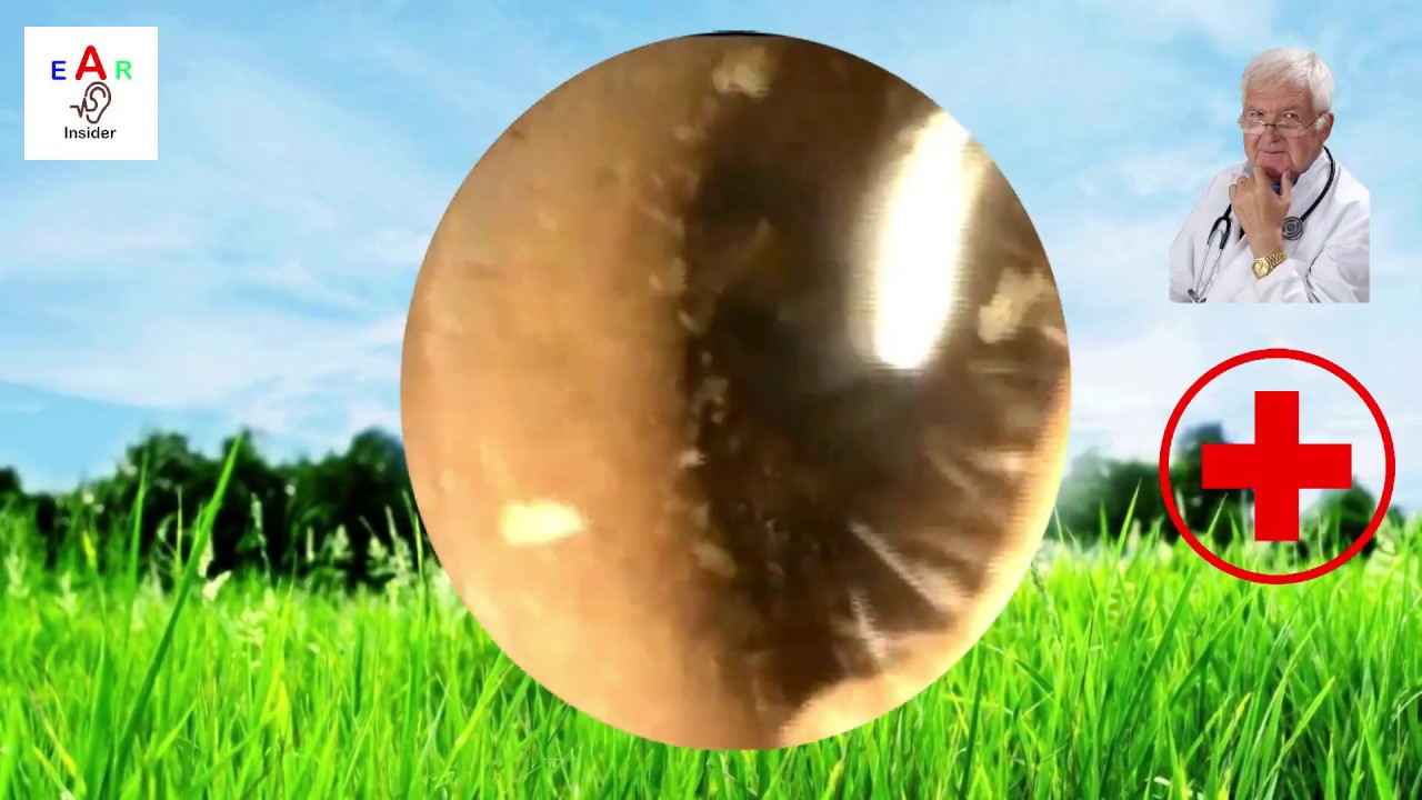 Ear Wax Extraction - Big Black Cerumen Inside the Ears for a Long Time ...