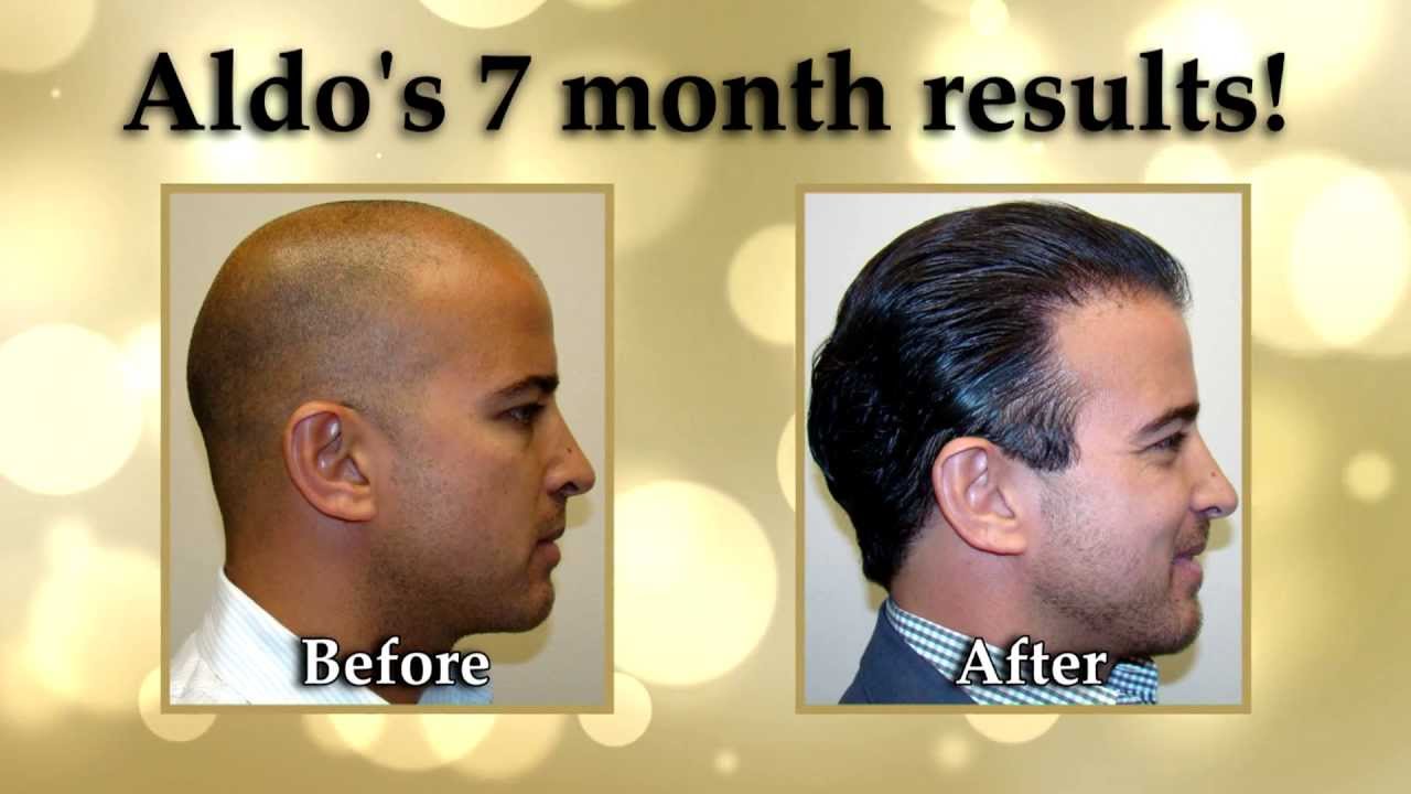 Dr. Brett Bolton Hair Transplant Surgery - YouTube
